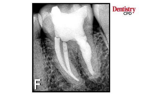 Dentistry Cpd Extensive Internal Root Resorption