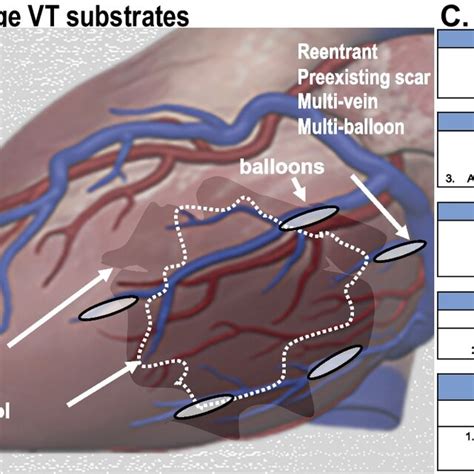 Venous Ethanol Ablation Approaches For Radiofrequency Refractory