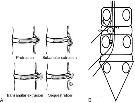 Lumbar Disc Herniation Clinical Tree