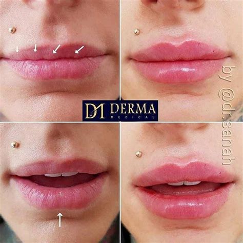 Bad Lip Injections Before And After