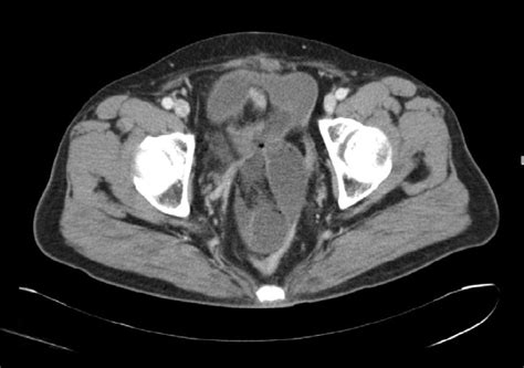 Abdomen And Pelvic Ct Abrupt Beak Shaped Luminal Obstruction Of Distal Download Scientific
