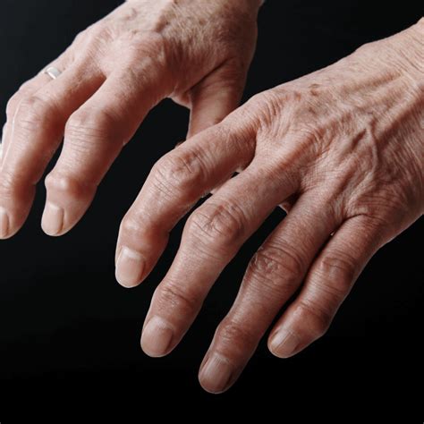 Arthrosis Types Symptoms And Treatment I Tech Medical Division