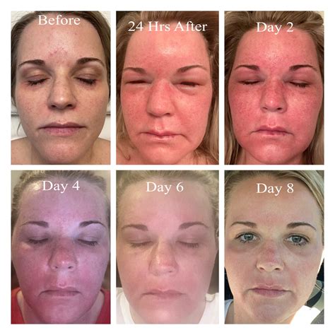 Halo Laser Recovery Photos Halo Laser™ Before And After Photos Anpbo