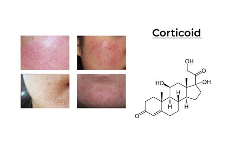 TÁC HẠI CỦA VIỆC LẠM DỤNG CORTICOID THỜI GIAN DÀI