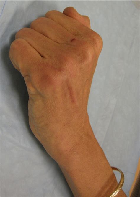 Figure 2 From Intramedullary Cannulated Headless Screw Fixation Of A Comminuted Subcapital