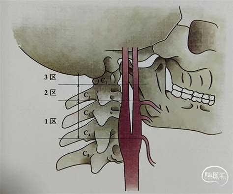 颈动脉内膜切除术（cea）学习笔记连载二（过程2） 脑医汇