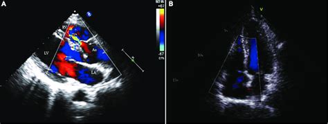 A The Two Dimensional Echocardiogram Showed A 106 Mm × 96 Mm