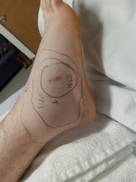 Garvin Co Volunteer Firefighter Recovering From Copperhead Snake Bite