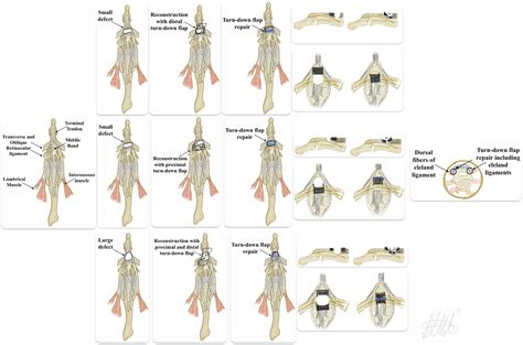 Reconstruction Of Zone 2 Extensor Tendon Defects With Split Thickness Turn Down Flap A New