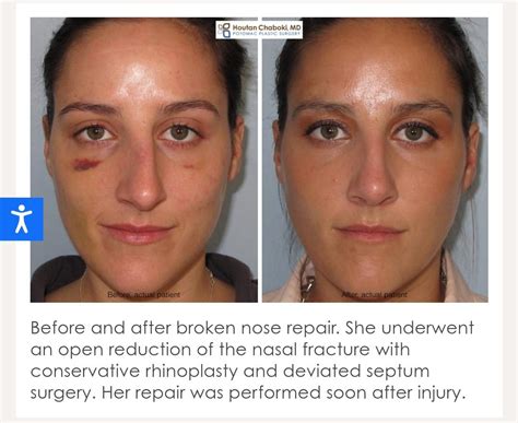 Broken Nose Before And After Rhinoplasty Before And After Photos