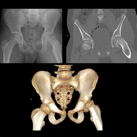 Slipped Capital Femoral Epiphysis Pediatric Radiology Reference