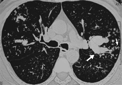 High Attenuation Mucus In Allergic Bronchopulmonary Aspergillosis