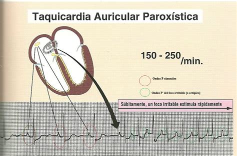 Electrocardiograma Taquicardia Paroxística Supraventricular