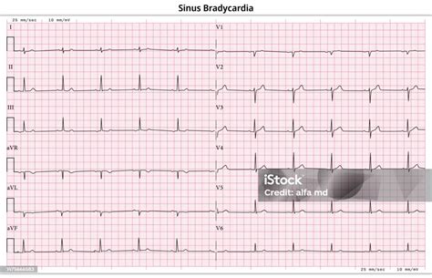 Ecg Sinus Bradycardia 12 Lead Ecg Common Case 6 Sec Lead Stock