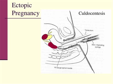 Ppt Ectopic Pregnancy Powerpoint Presentation Free Download Id6916819
