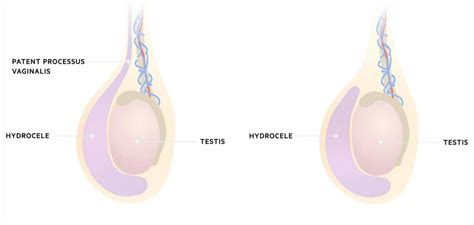 Hydrocele Symptoms Causes And Treatment