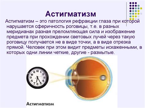 Врожденная миопия высокой степени: Врожденная близорукость у детей: что ...