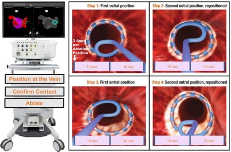 Logan S On Linkedin Varipulse A Step‐by‐step Guide To Pulmonary Vein