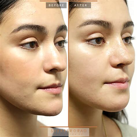 Chin Reduction In Washington Dc Sherber Rad