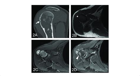 Low Grade Chondrosarcoma Involving The Humerus In A 57 Year Old Man
