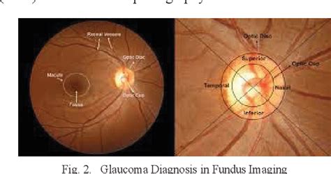 Figure 2 From Automated Detection Of Glaucoma From Fundus Images Using