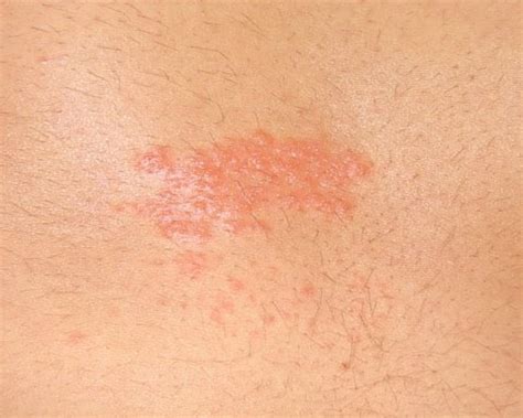 Fitness And Health Tips Skin Rash