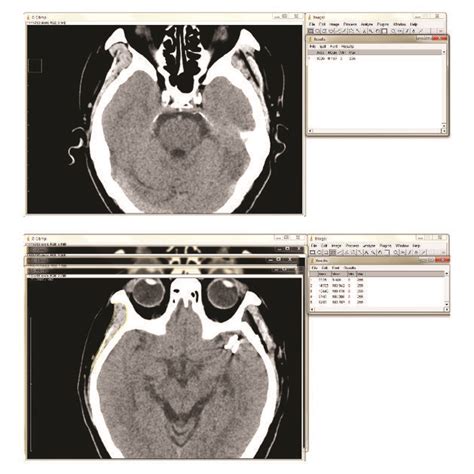 Intraoperative Photograph After Pterional Craniotomy The Bone Flap Was