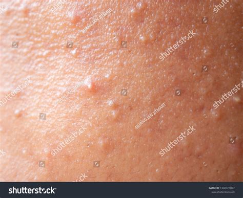 Papules Skin