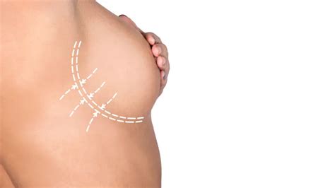 Costo De La Mastectomía Por Países