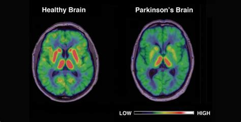 Causes And Impacts Of Parkinsons Disease