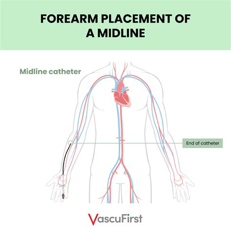 Picc Line Versus Midline Iv Central Venous Access Device And Site