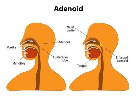 Know Everything About Adenoiditis And How Can It Affect You Tonsils And Adenoids Pediatric