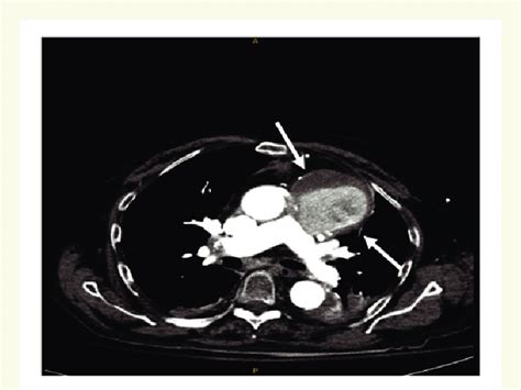 Cta Imaging Demonstrates The Expanding Pseudoaneurysm With Layering Of