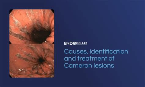 Endocollab™ Gi Endoscopy Education On Linkedin Cameron Lesions