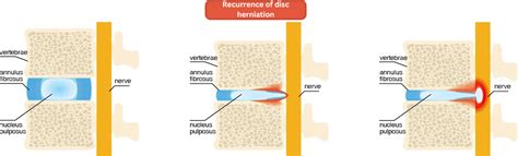 Recurrence And Reoperation Of Lumbar Disc Herniation Proper