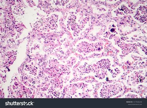 Lobar Pneumonia Red Hepatic Phase Light Micrograph Photo Under
