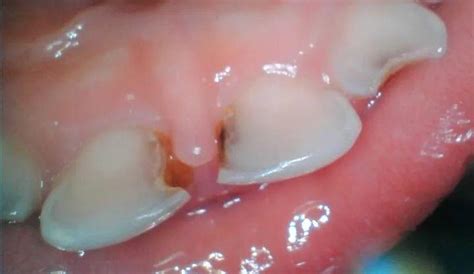 警惕！早期难以察觉的邻面龋，一坏就是两颗牙！ 知乎