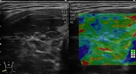 Head And Neck 41 Thyroid Gland Case 414 Thyroiditis And Diffuse