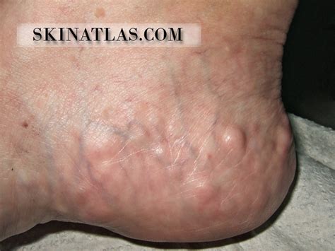 Piezogenic Pedal Papules