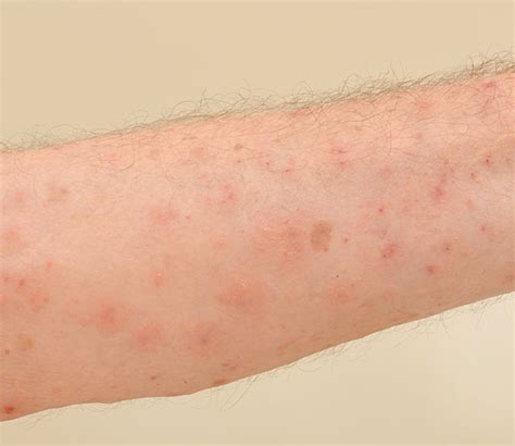 Scabies West Houston Dermatology