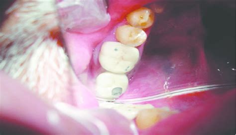 Screw Retained Prosthesis In Place Download Scientific Diagram