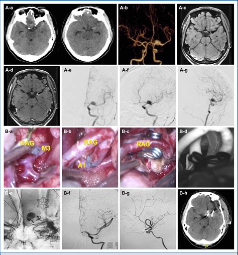 Figure 1 From Interposition Intracranial Intracranial Bypass Based On Anterior Cerebral Artery