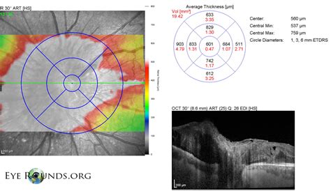 Atlas Entry Peripapillary Combined Hamartoma Of The Retina And