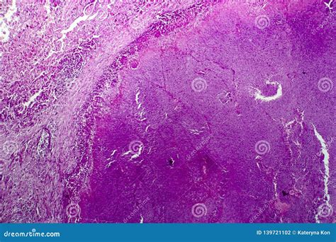 Caseous Necrosis Of Lymphatic Node Royalty Free Stock Image 121116142