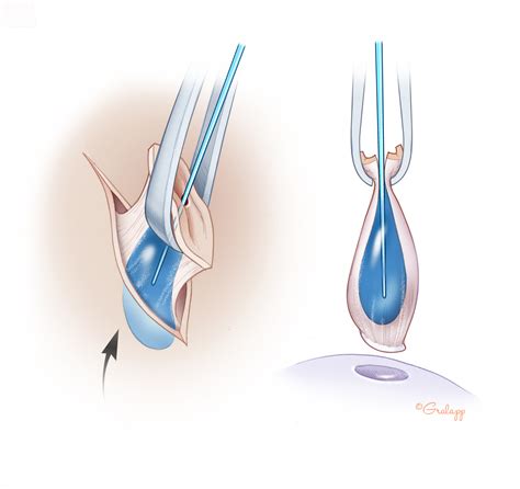 Preauricular Cyst Excision Oto Surgery Atlas