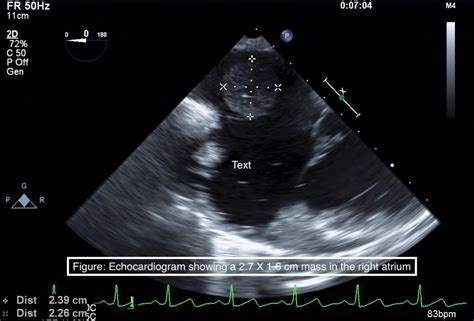 Ectopic Liver Tissue Presenting As A Right Atrial Mass Jacc