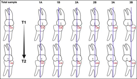 Factors Influencing Molar Relationship Behavior In The Mixed Dentition Pocket Dentistry