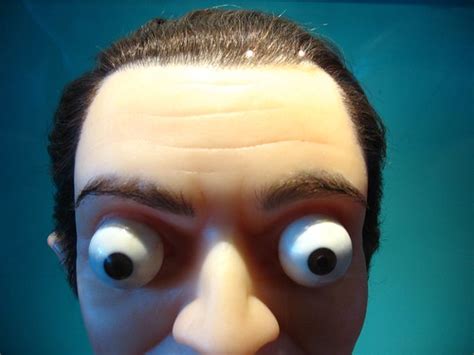 Eye Abnormalities Flashcards Quizlet