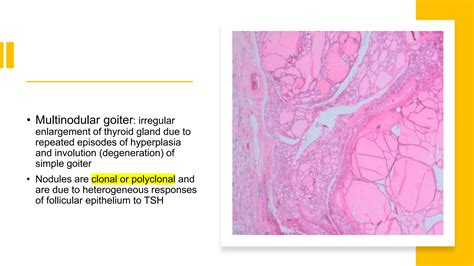 Thyroid Neoplasms An Update Based On Latest Who Pptx