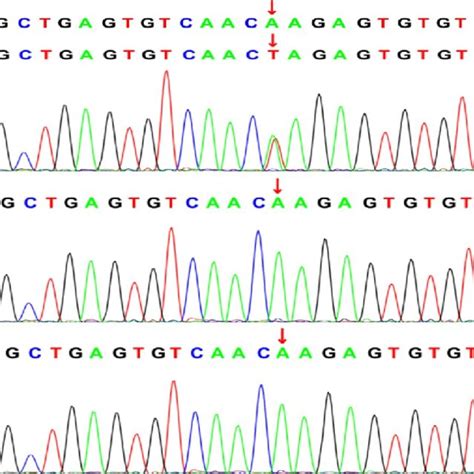Sanger Sequencing Results Of Case 2 A Denovo Heterozygous Missense